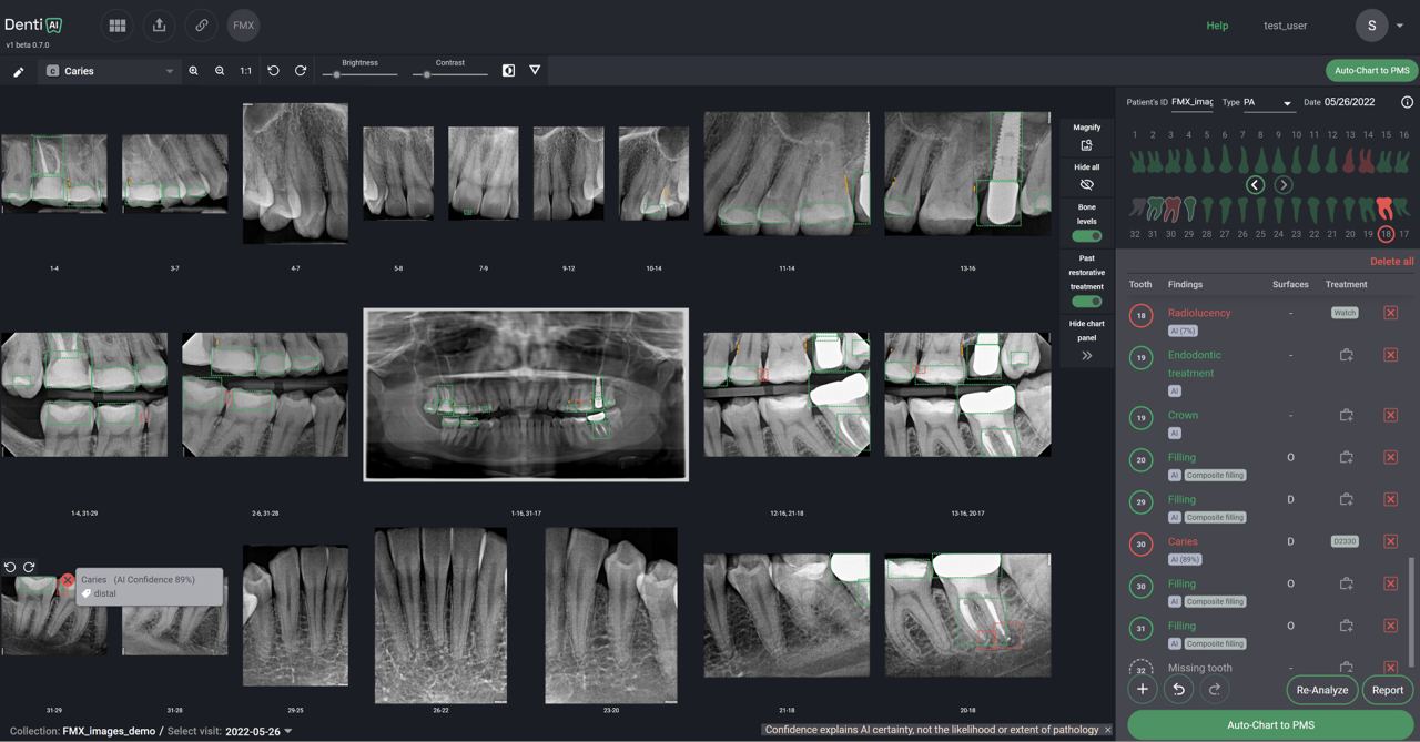 Denti.AI: AI for Dental X-Ray Imaging and Voice Charting