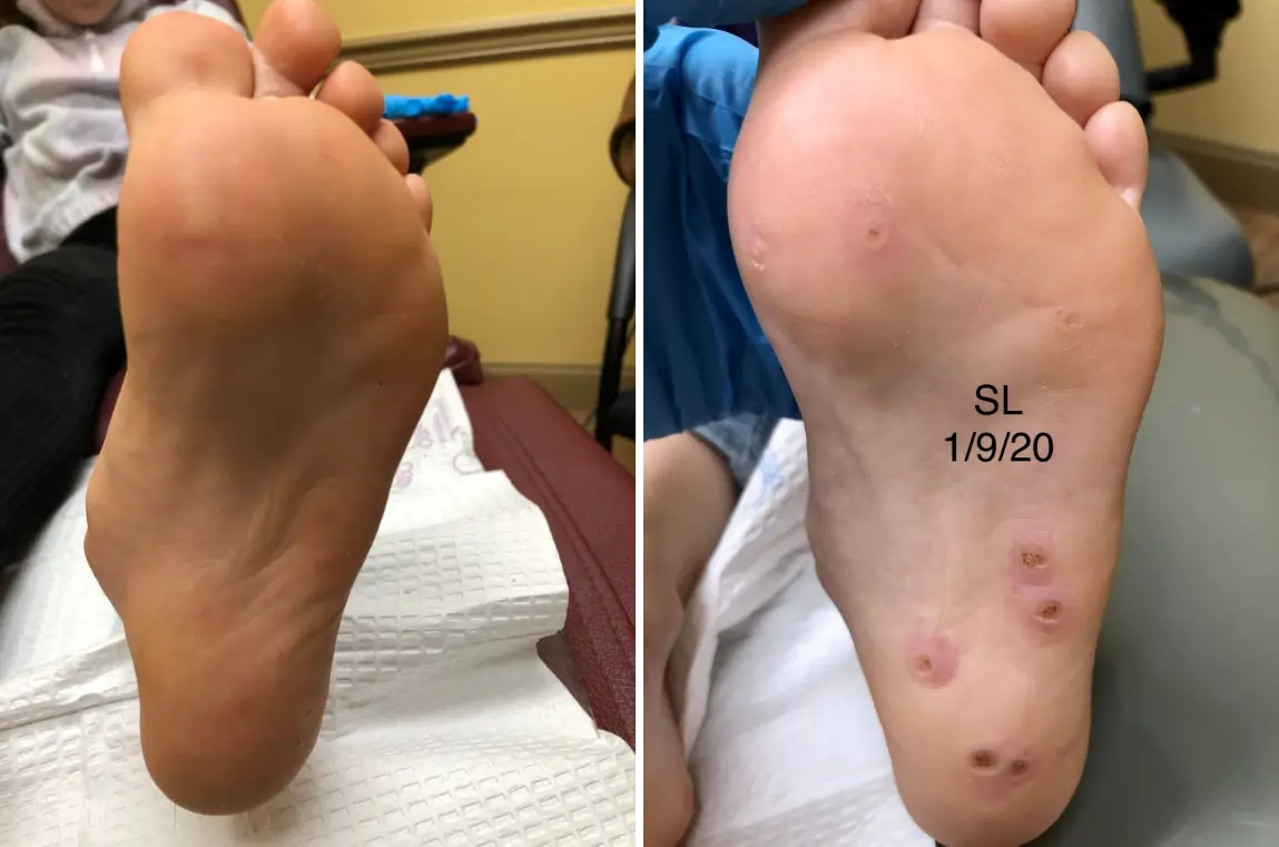 Swift Technology for Warts at Diablo Foot & Ankle | Podiatrist in ...