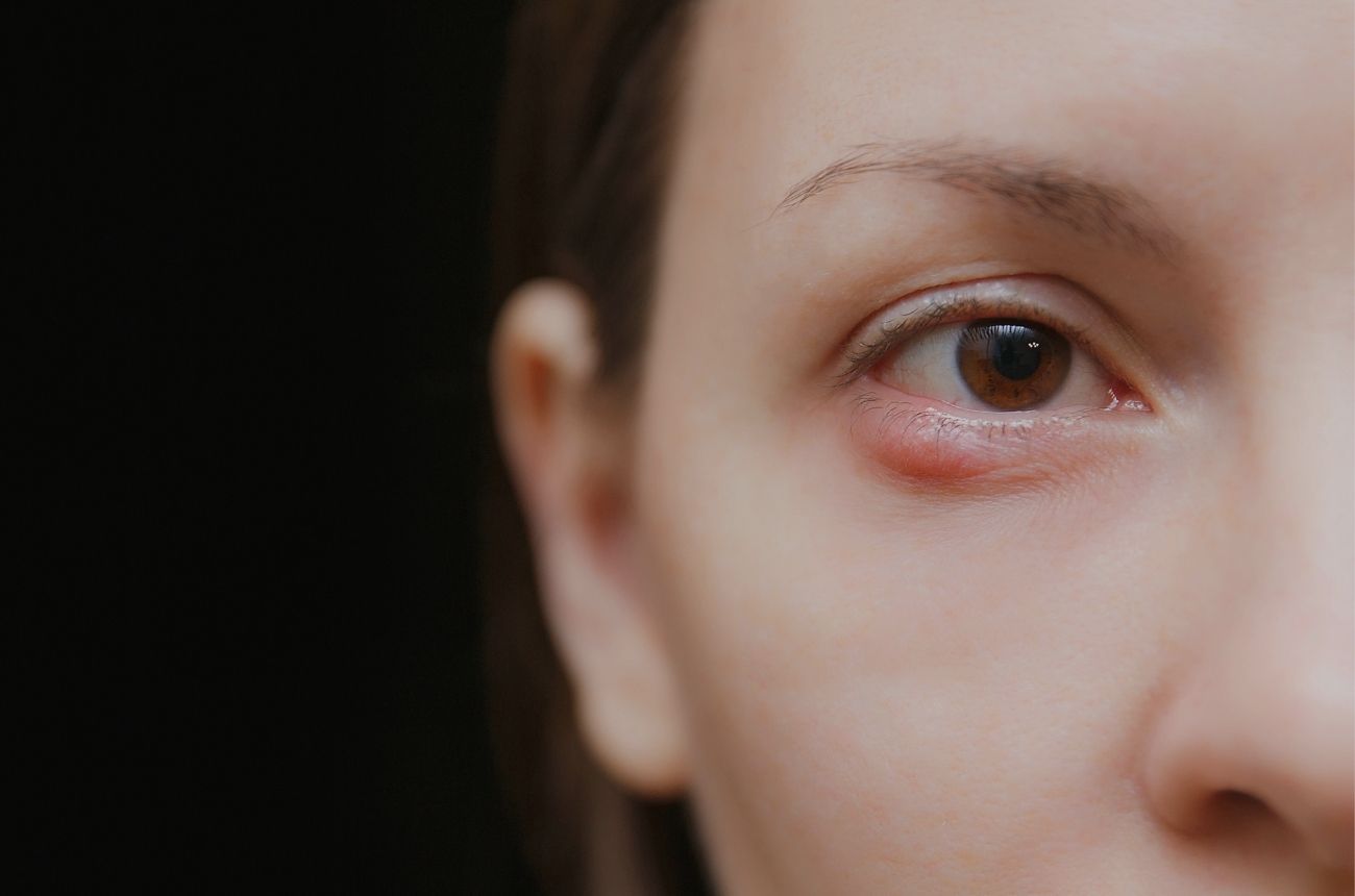 Sty - Stye: Symptoms, Causes, diagnosis, Treatment | cult.fit