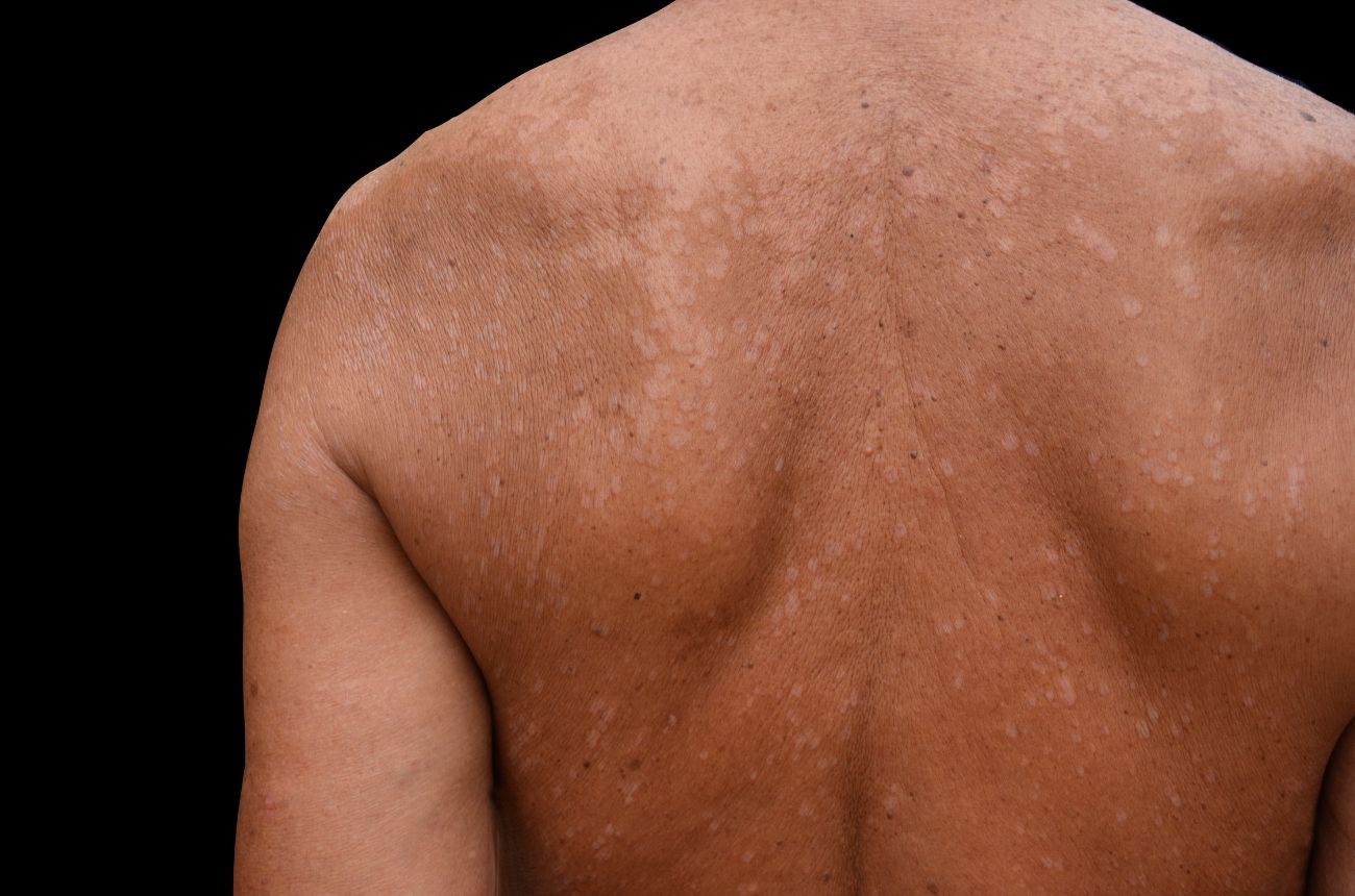 Pityriasis Versicolor Symptoms, Casues, Diagnosis, & More at blog.cult.fit