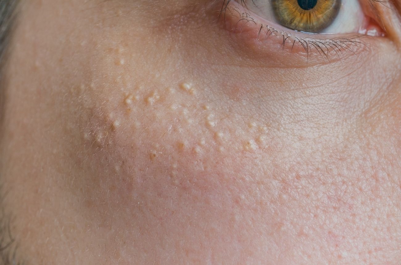 Milia Types, Symptoms, Causes, Diagnosis, & Treatment At blog.cult.fit