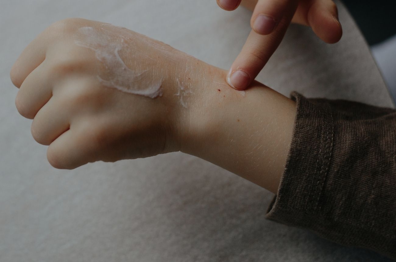 Intertrigo Symptoms, Types, Causes, Diagnosis & Treatment At blog.cult.fit