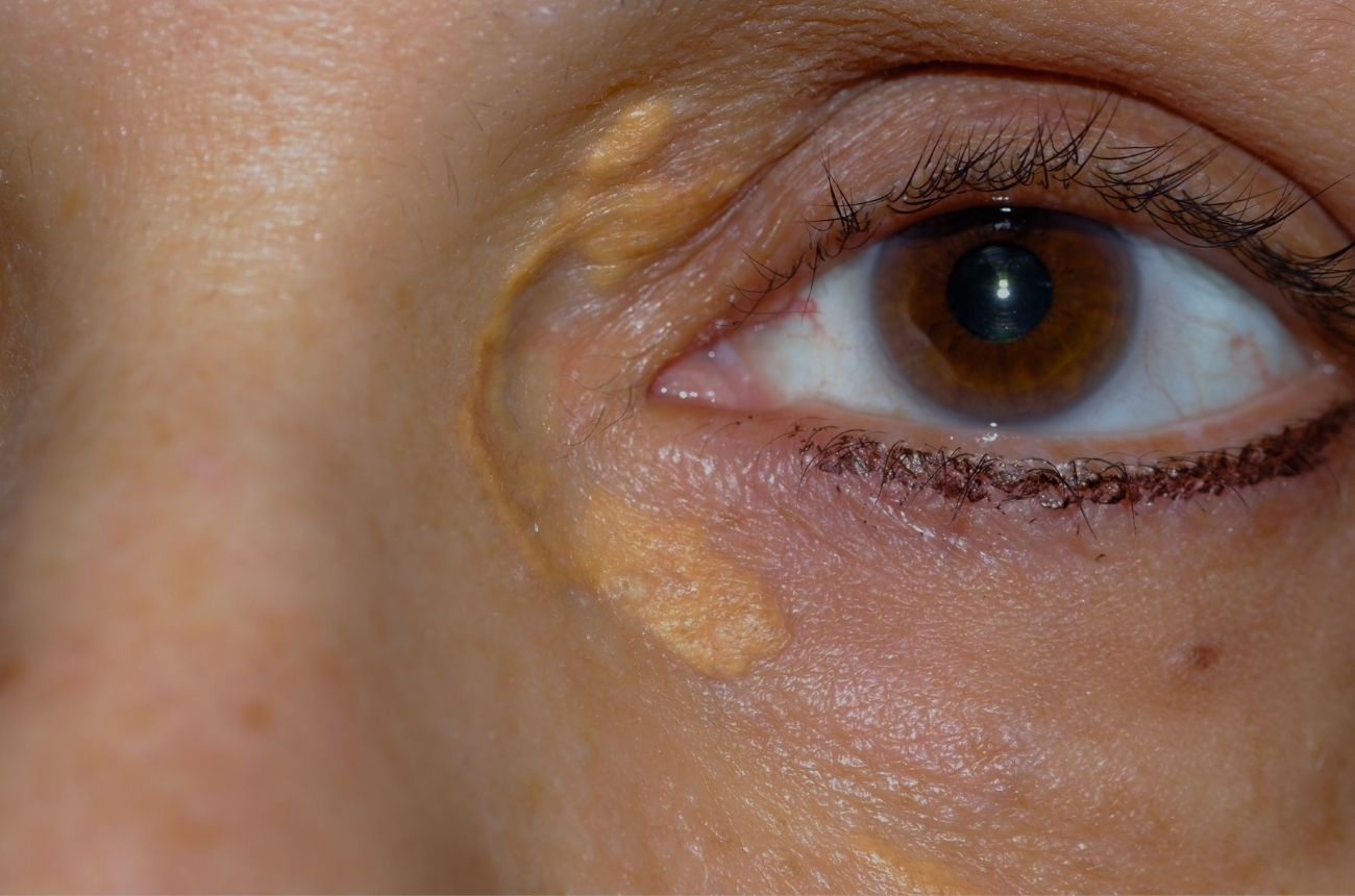 Xanthelasma | Meaning, Casues & Prevention | blog.cult.fit