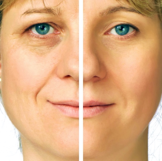 Acupuncture Hub - Cosmetic Acupuncture