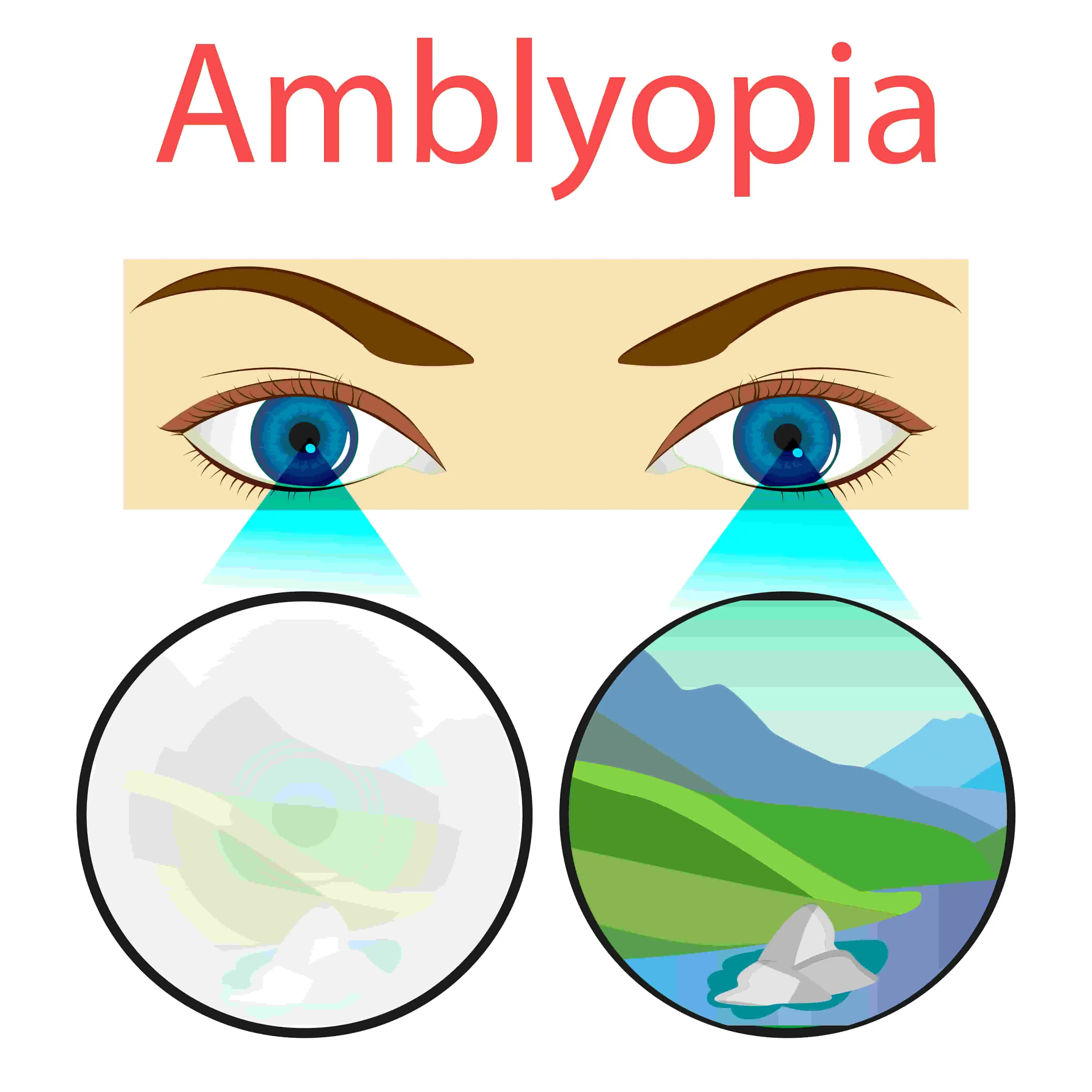 Amblyopia (Lazy Eye) Treatment in Chicago, IL | Kraff Eye Institute