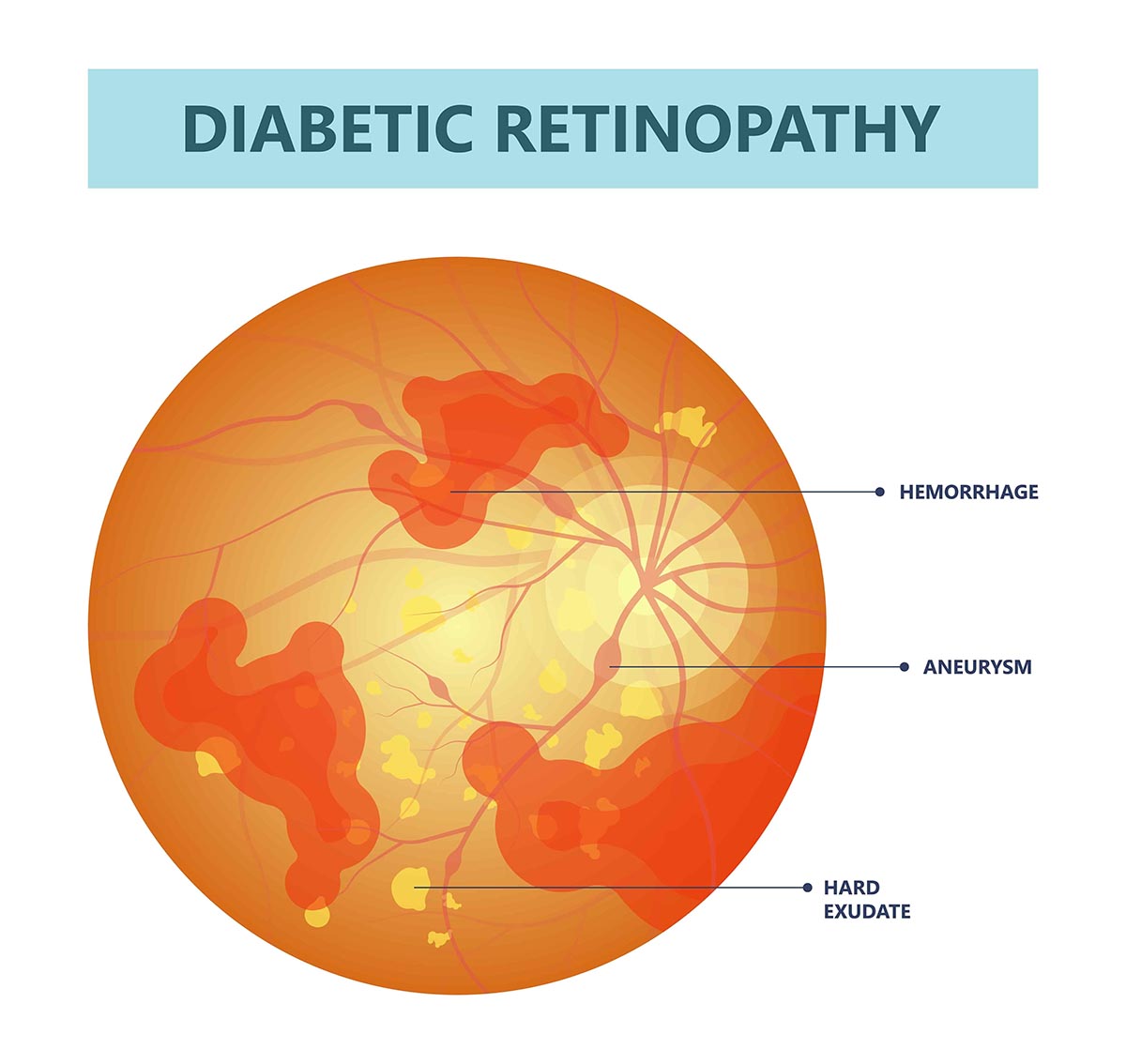 Diabetic Retinopathy Treatment in Chicago | Kraff Eye
