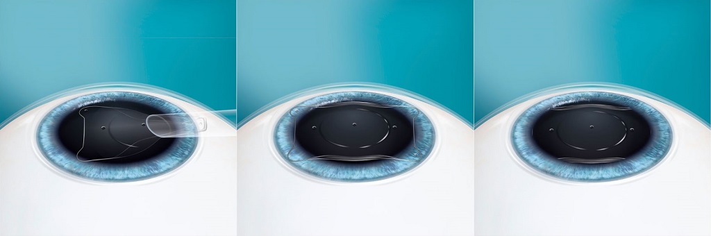 Implantable Collamer Lens Surgery | Kraff Eye Institute