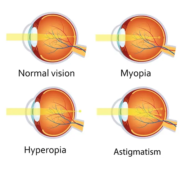 Implantable Collamer Lens Surgery | Kraff Eye Institute