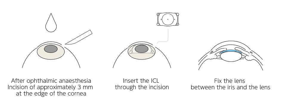Implantable Collamer Lens Surgery | Kraff Eye Institute