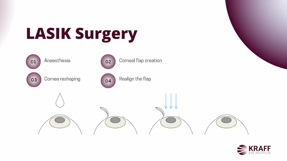 LASIK | LASIK Eye Surgery Chicago | Kraff Eye Institute