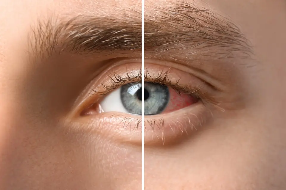 Refractive Lens Exchange (RLE) in Chicago | Kraff Eye Institute