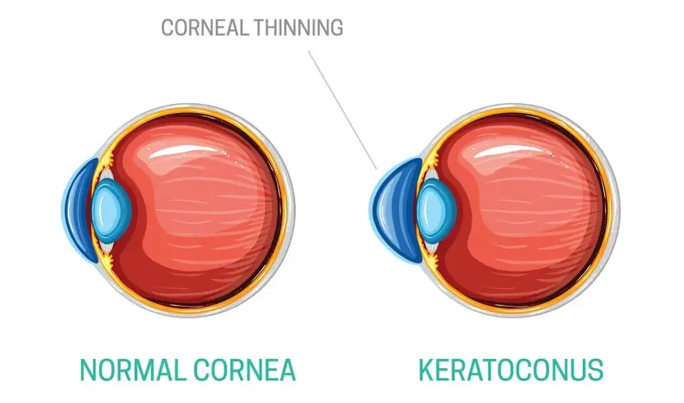 Is Astigmatism the Same as Keratoconus? | Kraff Eye Institute