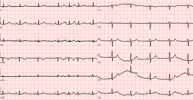 Ecg With Supraventricular Extrasystole And Phonendoscope Premature | My ...