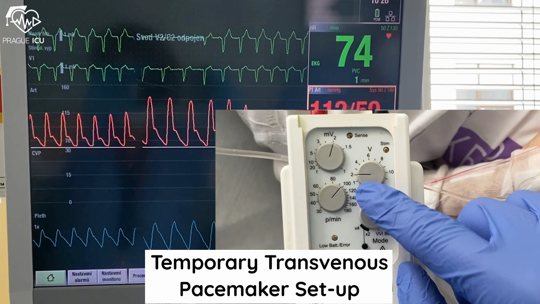 Workflow Blog: Temporary transvenous pacemaker set-up