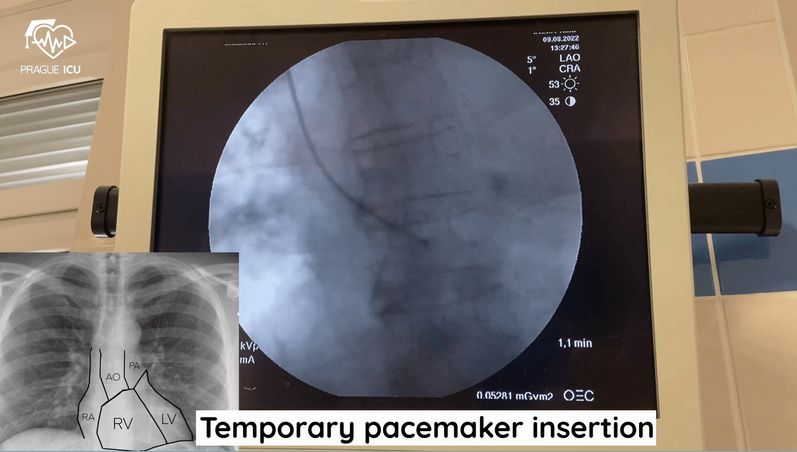 Workflow Blog: Temporary pacemaker insertion