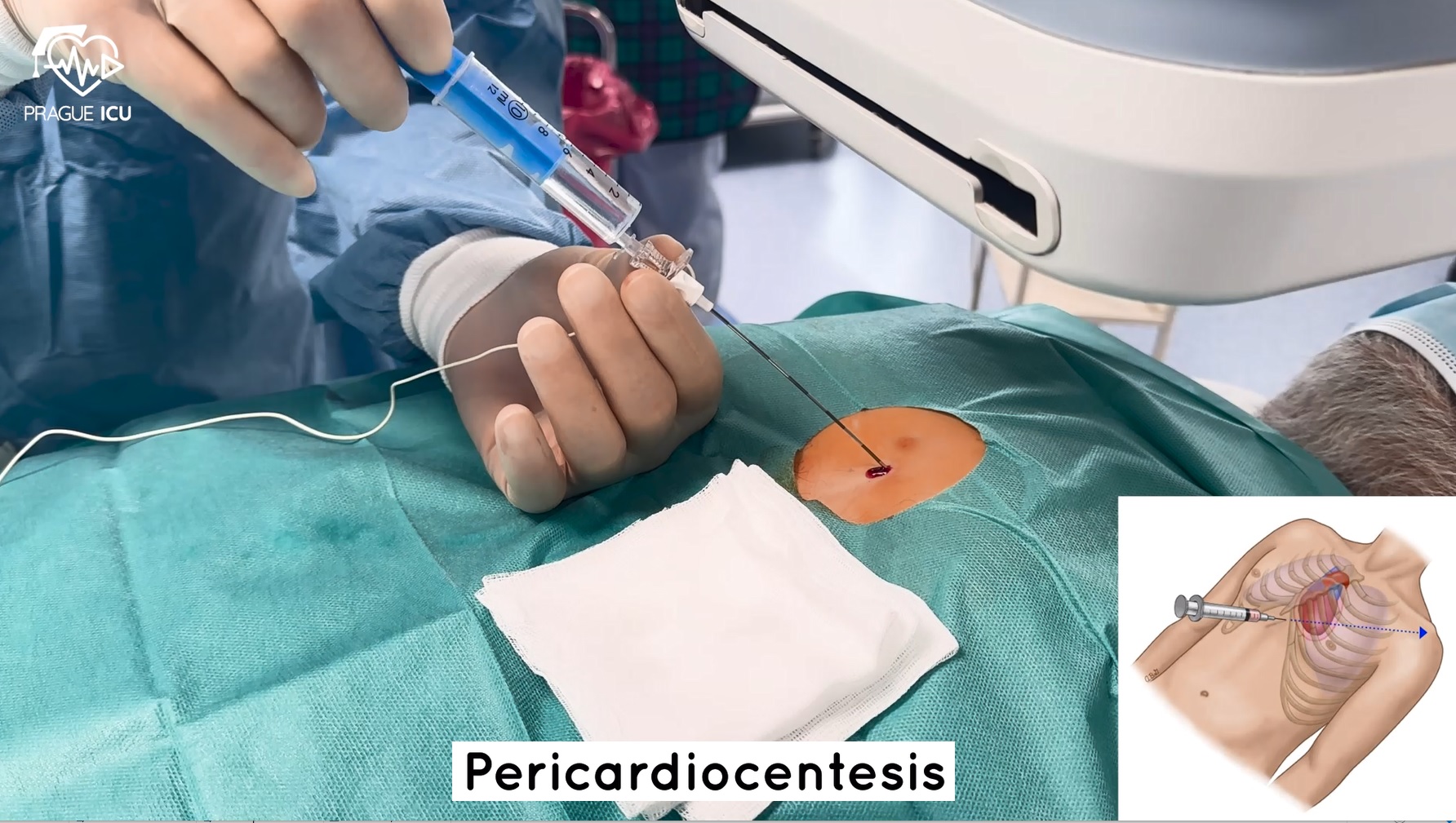 Workflow Blog: Pericardiocentesis