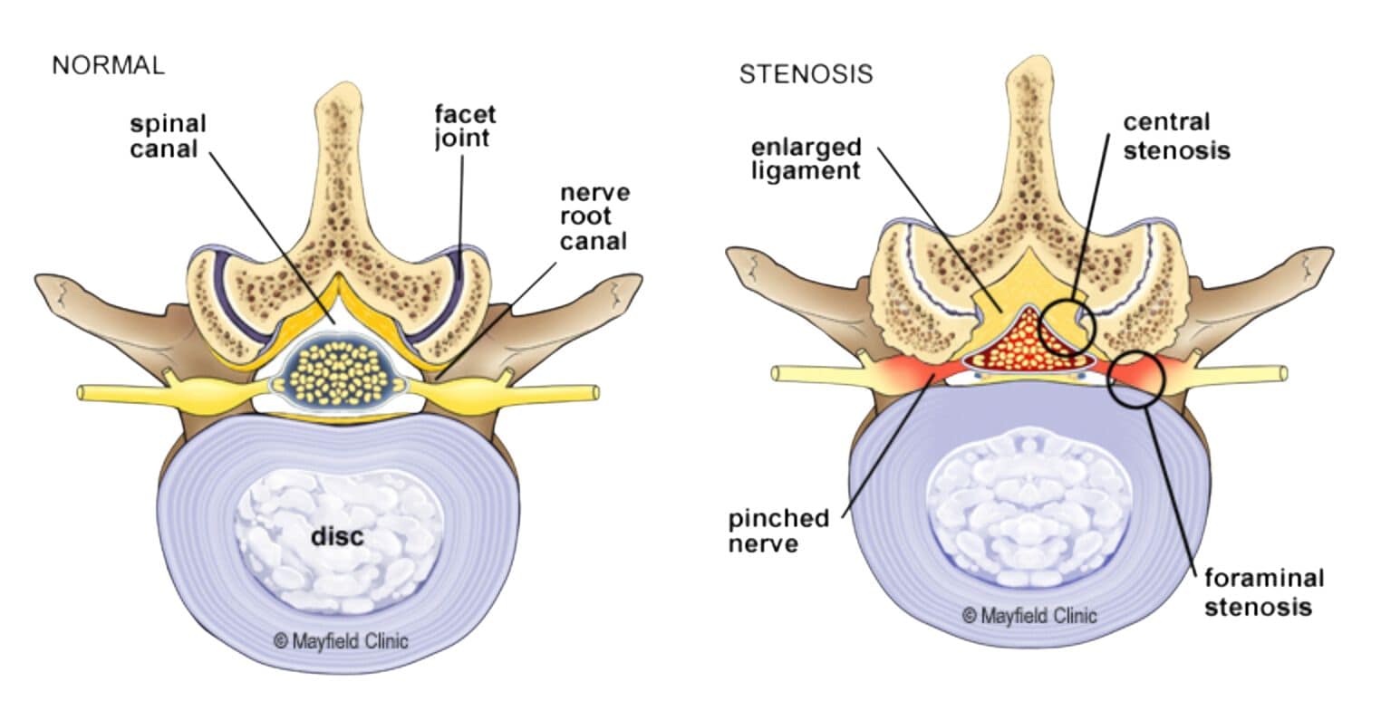Discover a Risk-Free Approach to Fixing Spinal Stenosis!