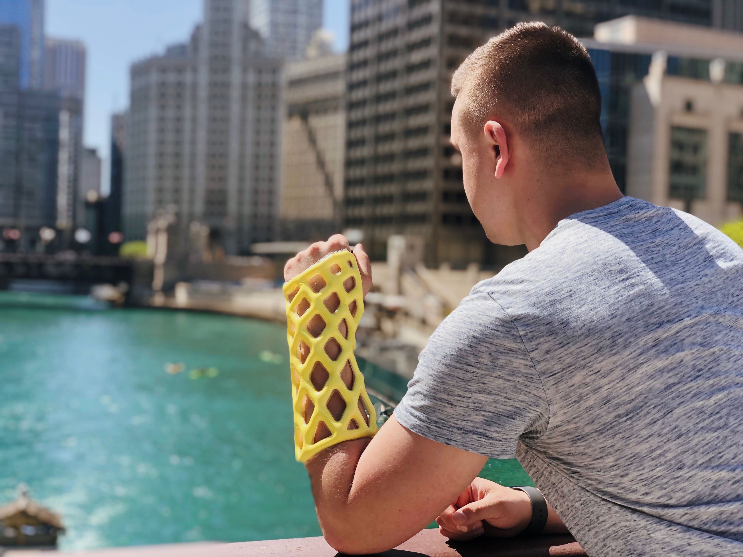 Everything You Need to Know About Arm Casts