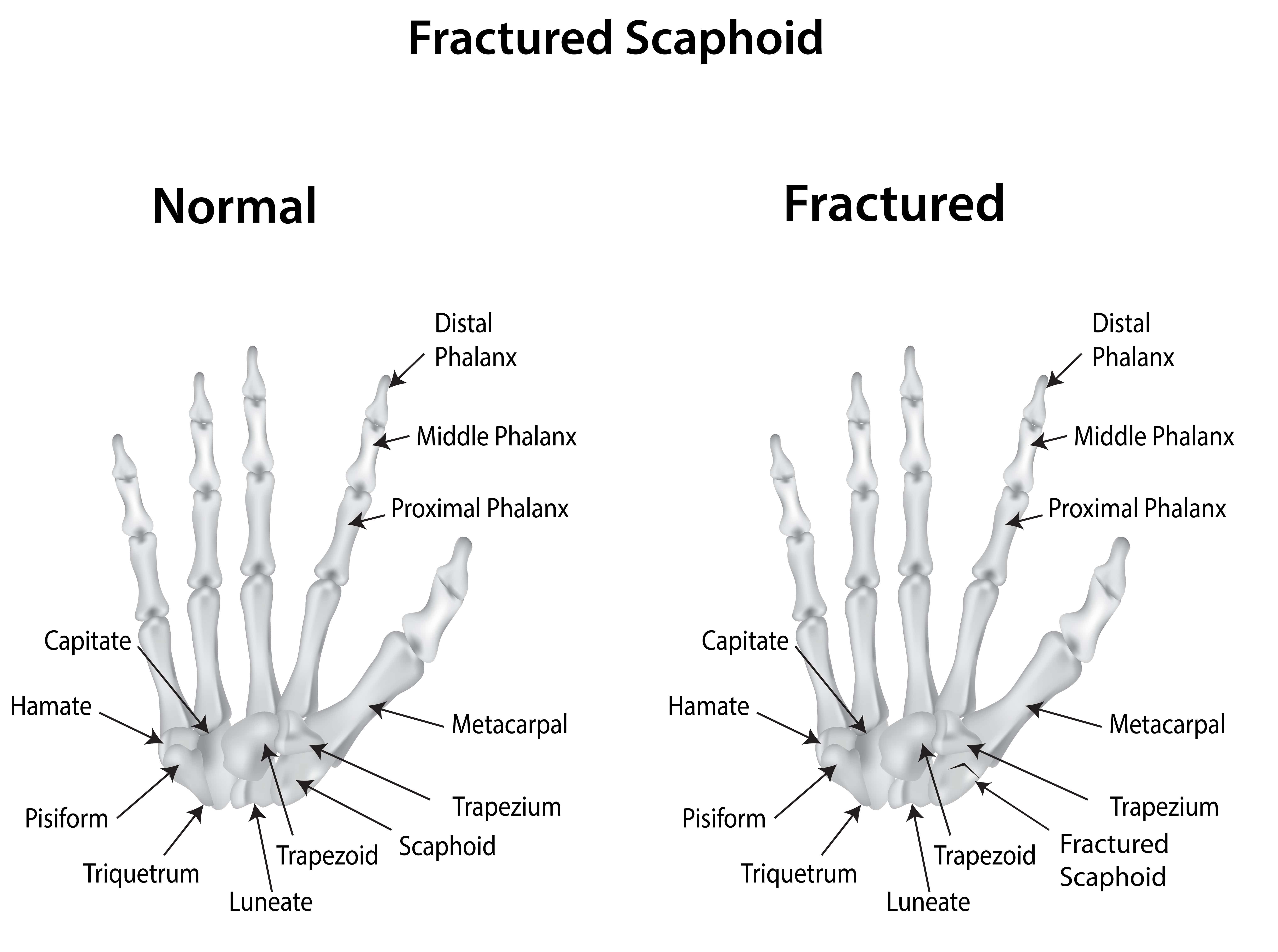 Scaphoid Fracture: Causes, Treatment, and Recovery