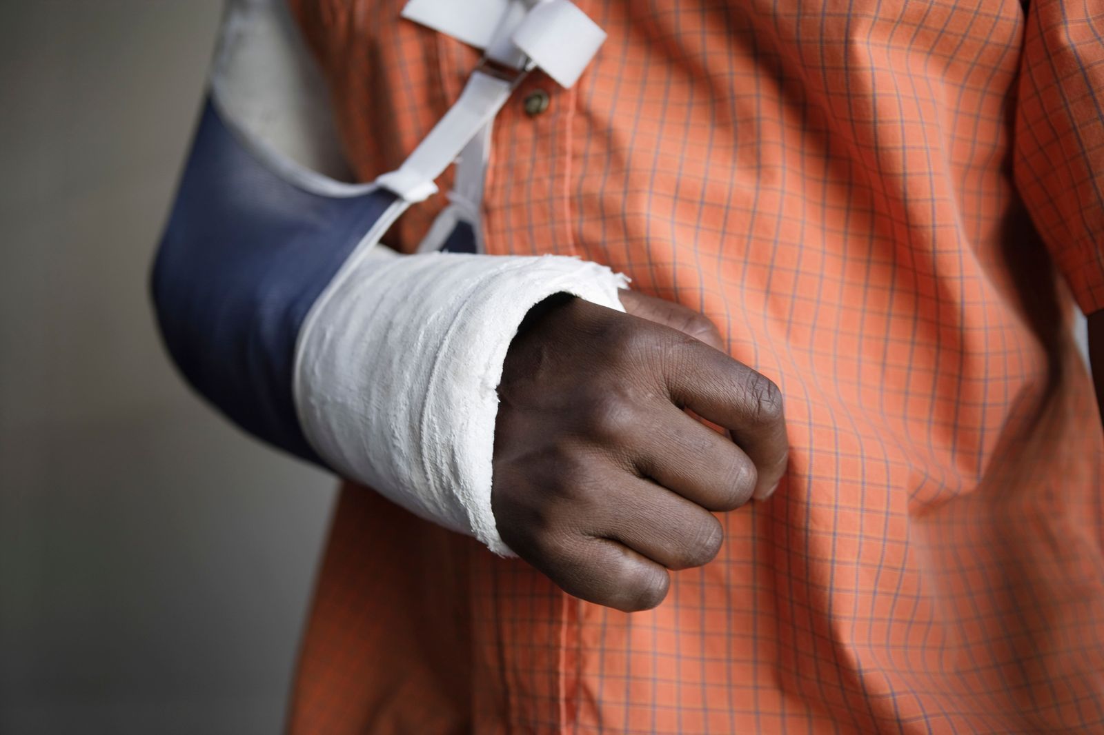 When Can You Skip the Cast? A Closer Look at Broken Bones