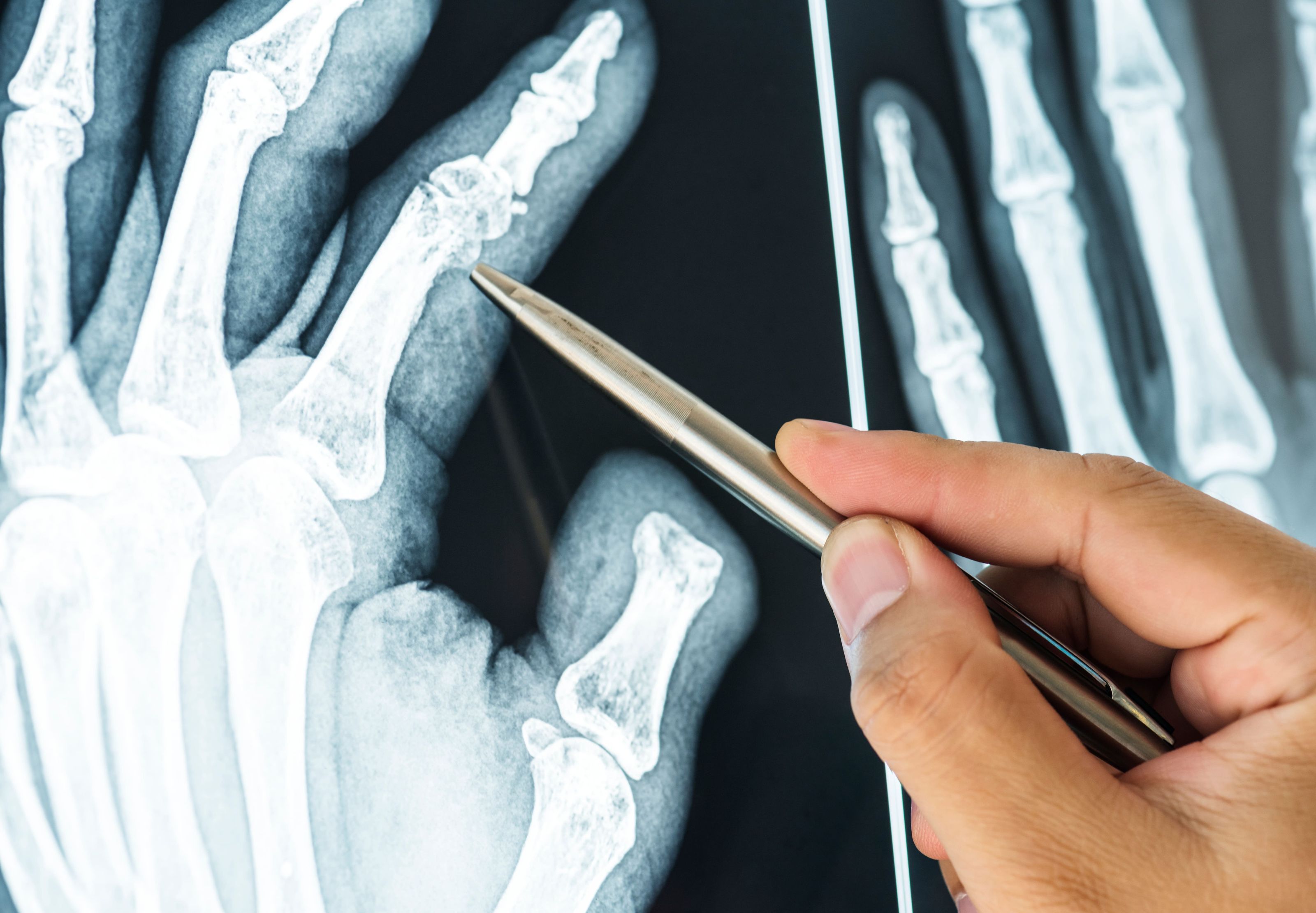 How to Tell the Difference Between a Malunion and Nonunion Fracture