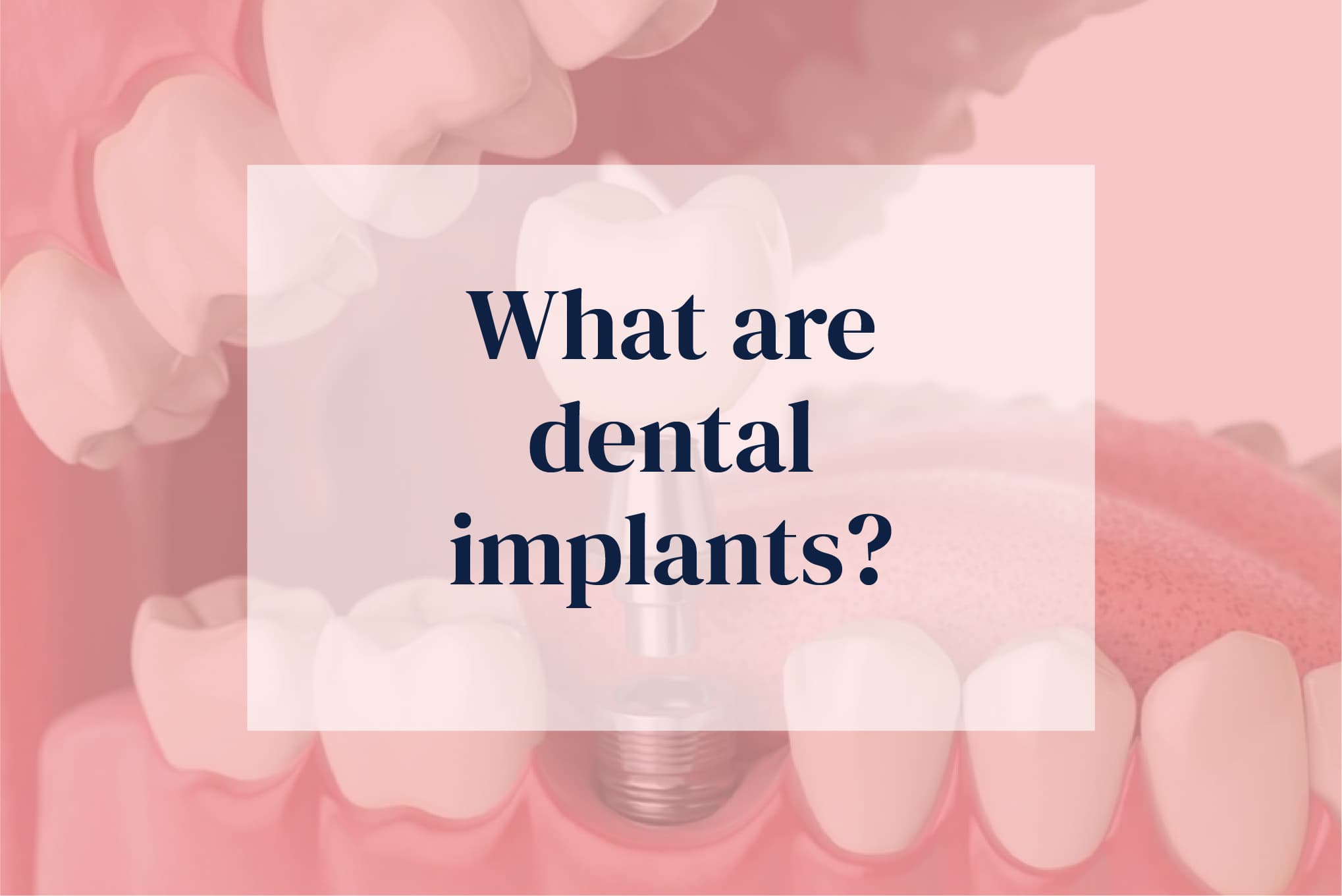 Trident Smiles Dental | What are dental implants?