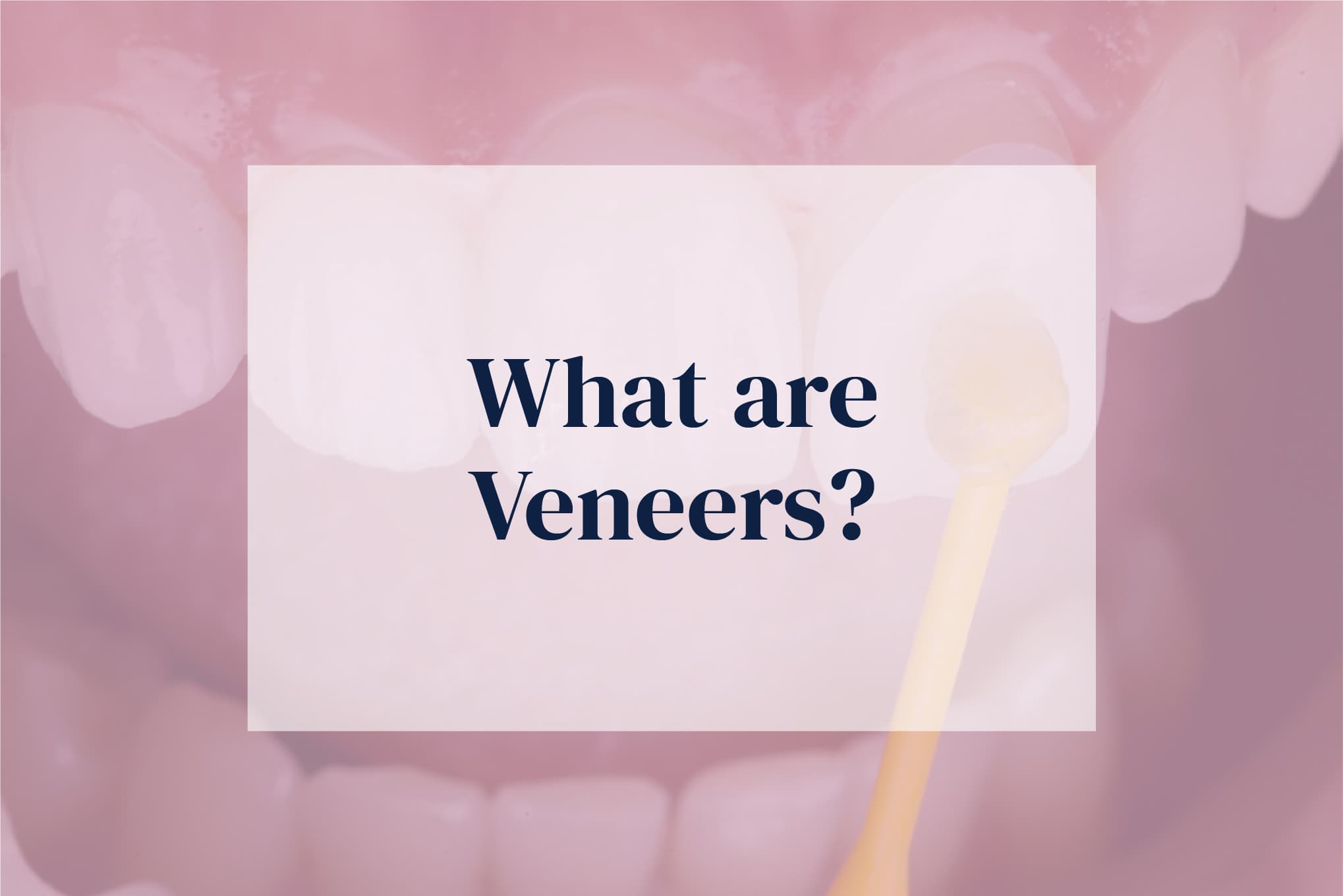 Trident Smiles Dental | What are veneers?