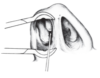 Rhino-Pro Curette Rapid Viral Testing | Arlington Scientific