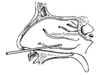 Rhino-Pro Curette Rapid Viral Testing | Arlington Scientific