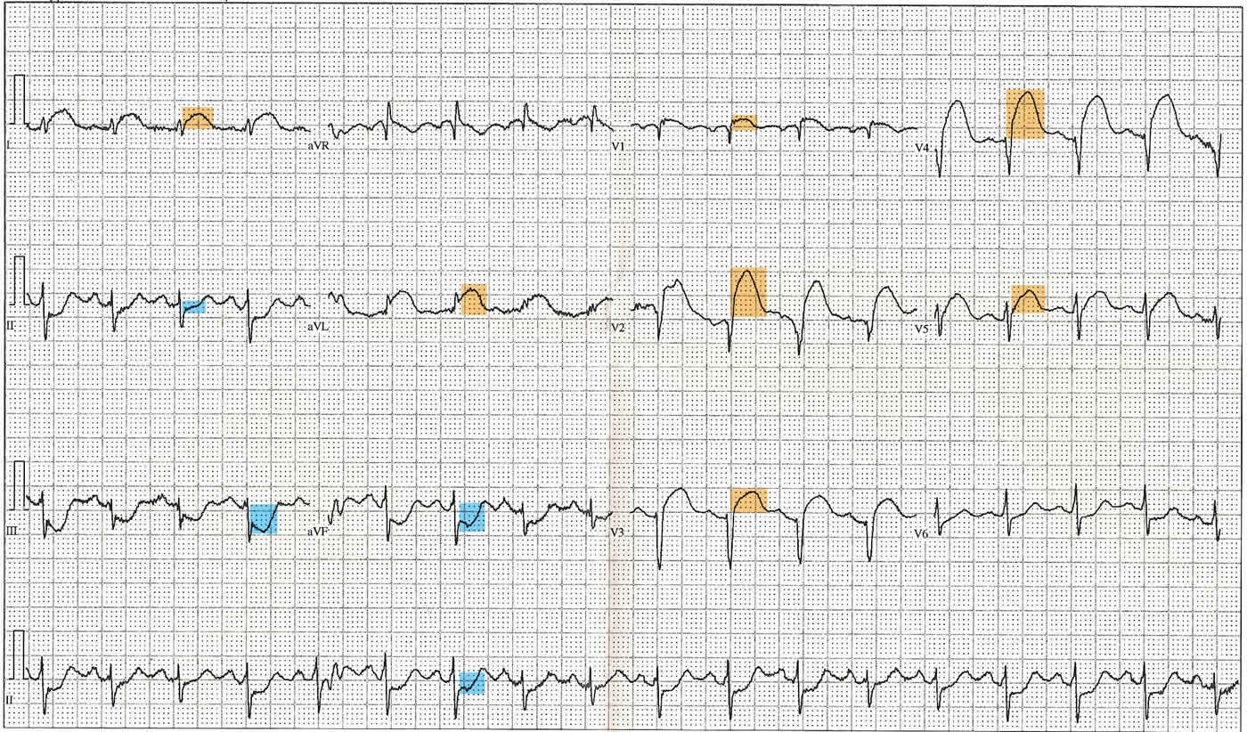 Electrocardiography (ECG) — Medistudents