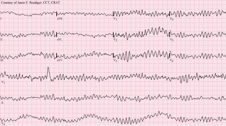 Electrocardiography (ECG) — Medistudents