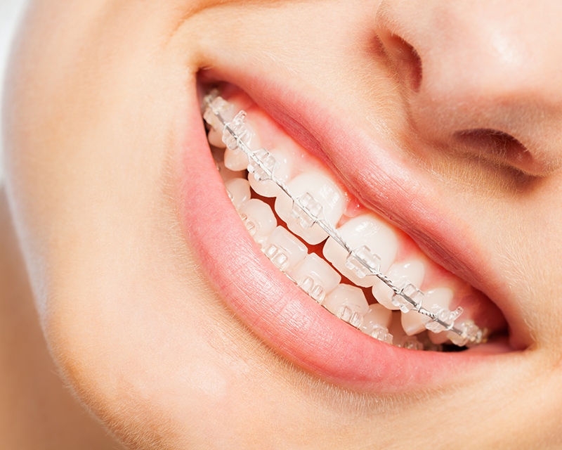 Jenis-Jenis Braces dan Perbezaan Antaranya