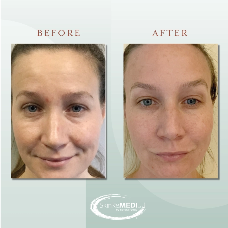 Med Spa Before & After Results | Natural Body Spa & SkinReMEDI ...
