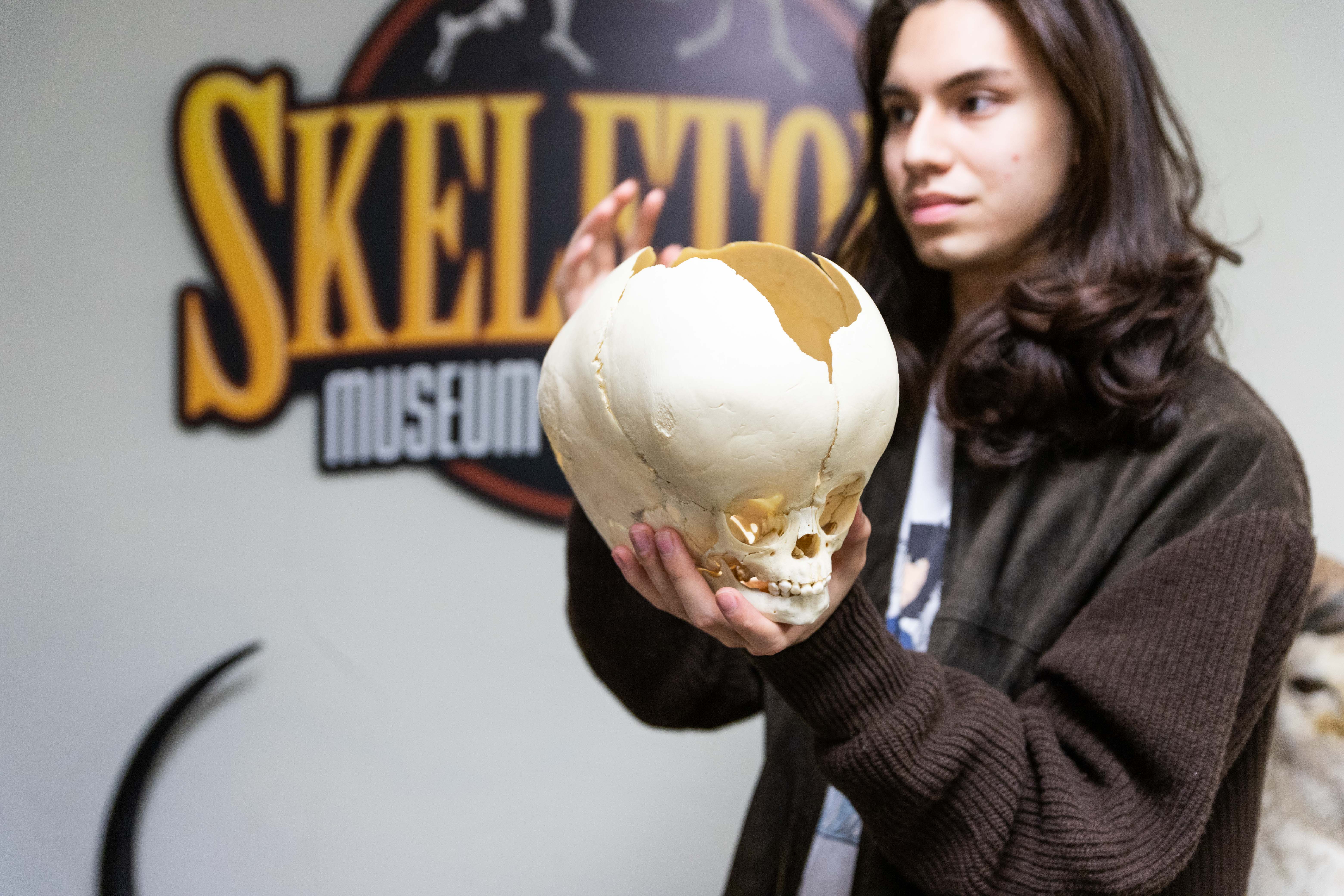 Water On The Brain: What is hydrocephaly | JonsBones: Osteology Education