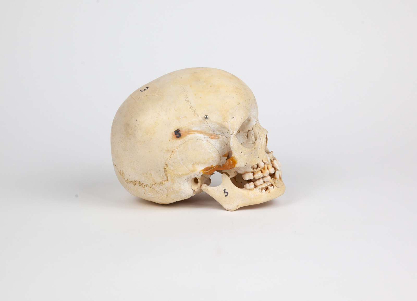 Pediatric Skull (0240) | JonsBones: Responsibly Sourced Human Osteology