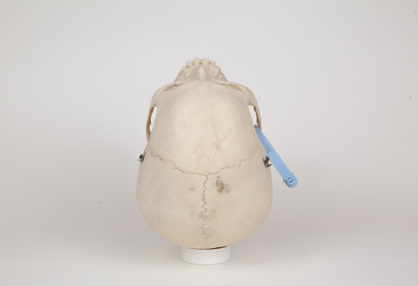 Medical Skull with Fused Atlas (0276) | JonsBones: Responsibly Sourced ...