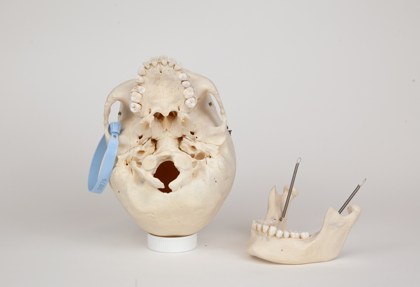 Medical Skull with Fused Atlas (0276) | JonsBones: Responsibly Sourced ...