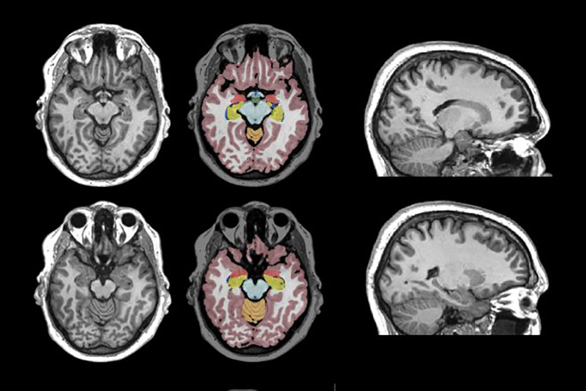 Interview: Ageing people grow just as many new brain cells as young people