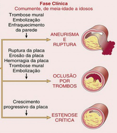 Cardiologia: O que é angina estável e como reconhecê-la?