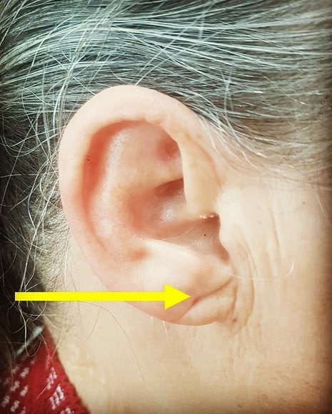 Cardiologia: O que é angina estável e como reconhecê-la?