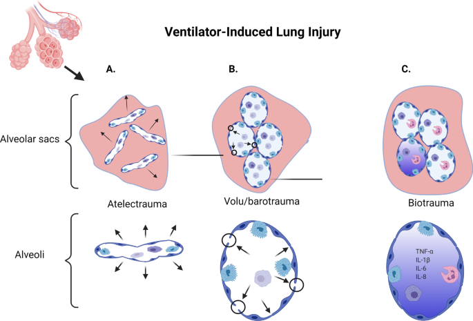 Pneumologia: O que é PEEP e como calcular seu valor ideal