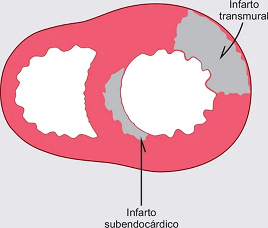 Cardiologia: Síndrome coronariana aguda: como é realizado o tratamento ...