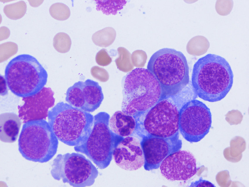 Hematologia: Anemia Megaloblástica: causas, diagnóstico e tratamento