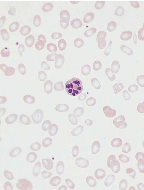 Hematologia: Anemia Megaloblástica: causas, diagnóstico e tratamento