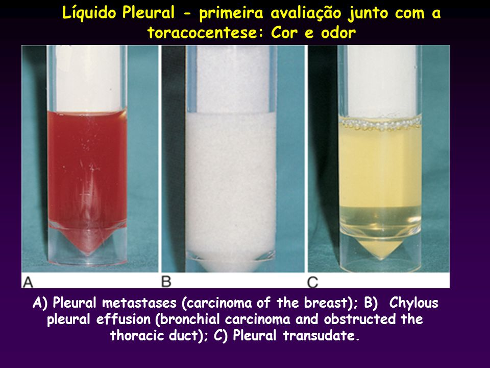 Clínica Médica: Derrame pleural: etiologias, sinais e sintomas e tratamento