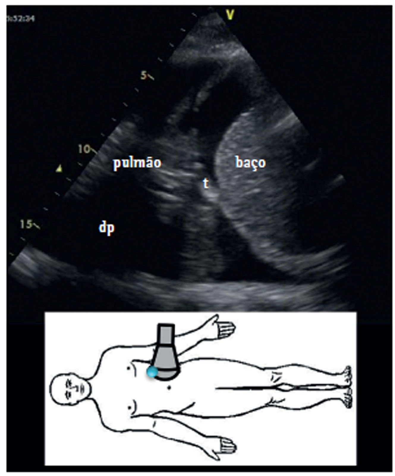 Clínica Médica: Derrame pleural: etiologias, sinais e sintomas e tratamento