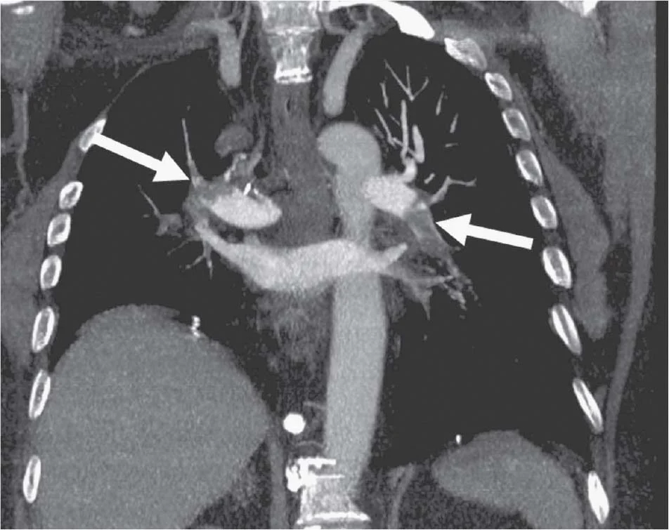 Cardiologia: Tromboembolismo venoso: o que é, como diagnosticar e tratar