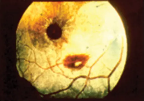Cardiologia: Endocardite Infecciosa: tipos, etiologias, diagnóstico e ...