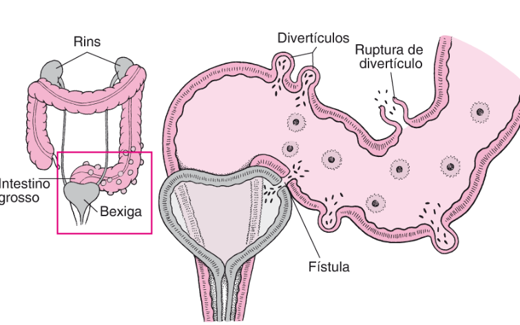 Cirurgia: Diverticulite aguda: fisiopatologia, sintomas e manejo
