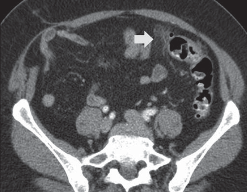 Cirurgia: Diverticulite aguda: fisiopatologia, sintomas e manejo